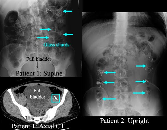 RadiologySpirit: Glass Shards in the GI Tract