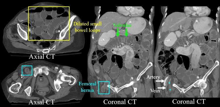 RadiologySpirit: Femoral Hernia with Small Bowel Obstruction on CT Scans