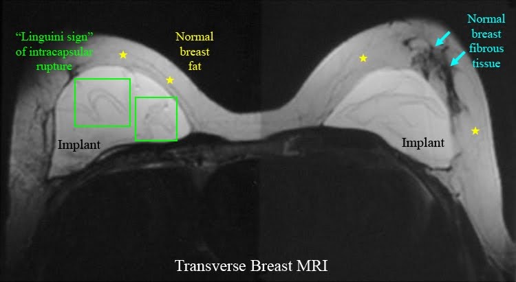 RadiologySpirit: Linguini Sign