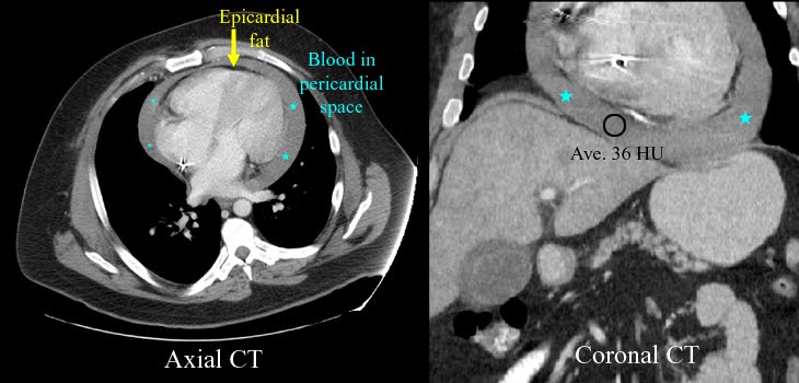 RadiologySpirit: Hemopericardium on CT Scans