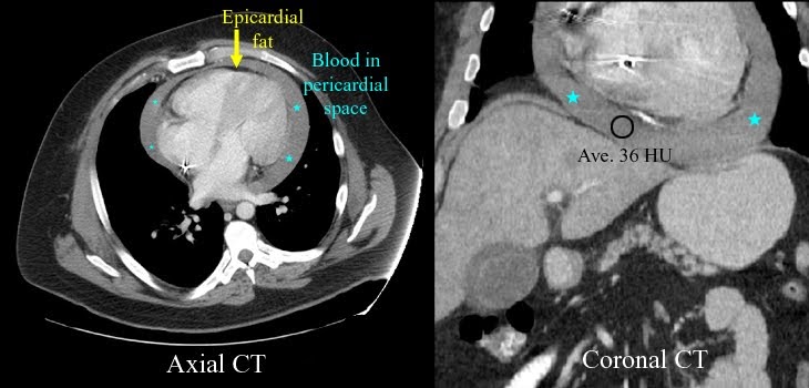 RadiologySpirit: Hemopericardium on CT Scans