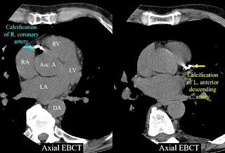 RadiologySpirit: Coronary Artery Calcifications on CT Scans