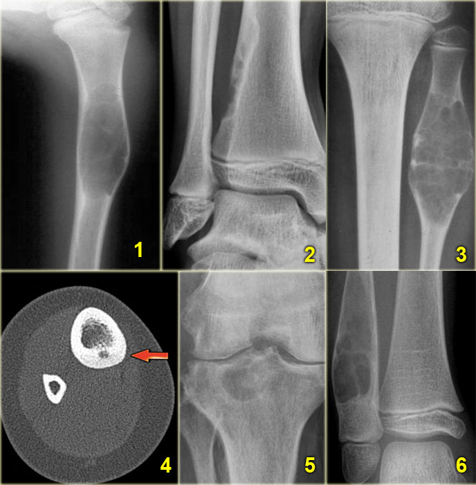 RadiologySpirit: Location: centric - eccentric - juxtacortical