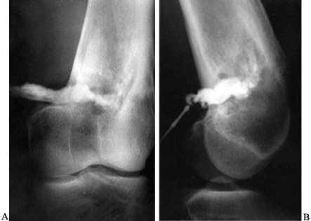 RadiologySpirit: sinogram+osteomylitis