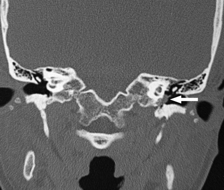 RadiologySpirit: glomus tympanicum