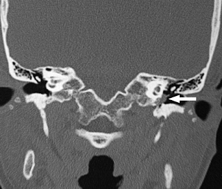 RadiologySpirit: glomus tympanicum