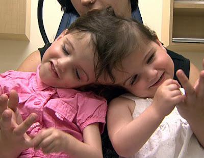 Free Amazing Images: Conjoined Twins Share a Brain