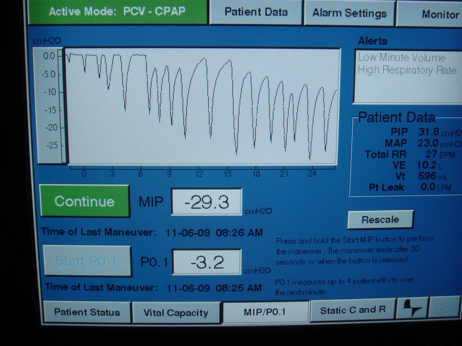 FREMITUS: The MIP: a review of obtaining Maximal Inspiratory Pressure