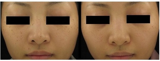 Taiwan Dermatologist Doctor Hu: Mercedes-level dual mode pulsed light ...