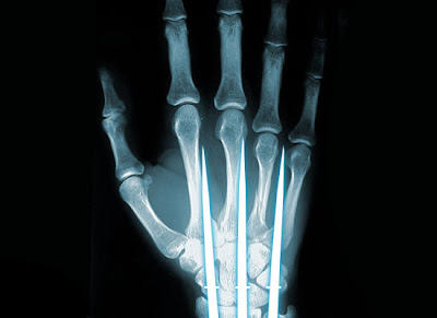 Claveles paralelos: Implantes raros para el cuerpo.