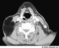 RADT413: Lipoma of the Neck