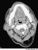 RADT413: Lipoma of the Neck