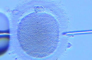 Infertility Guide: ICSI Procedure – Modern Fertilization Treatment