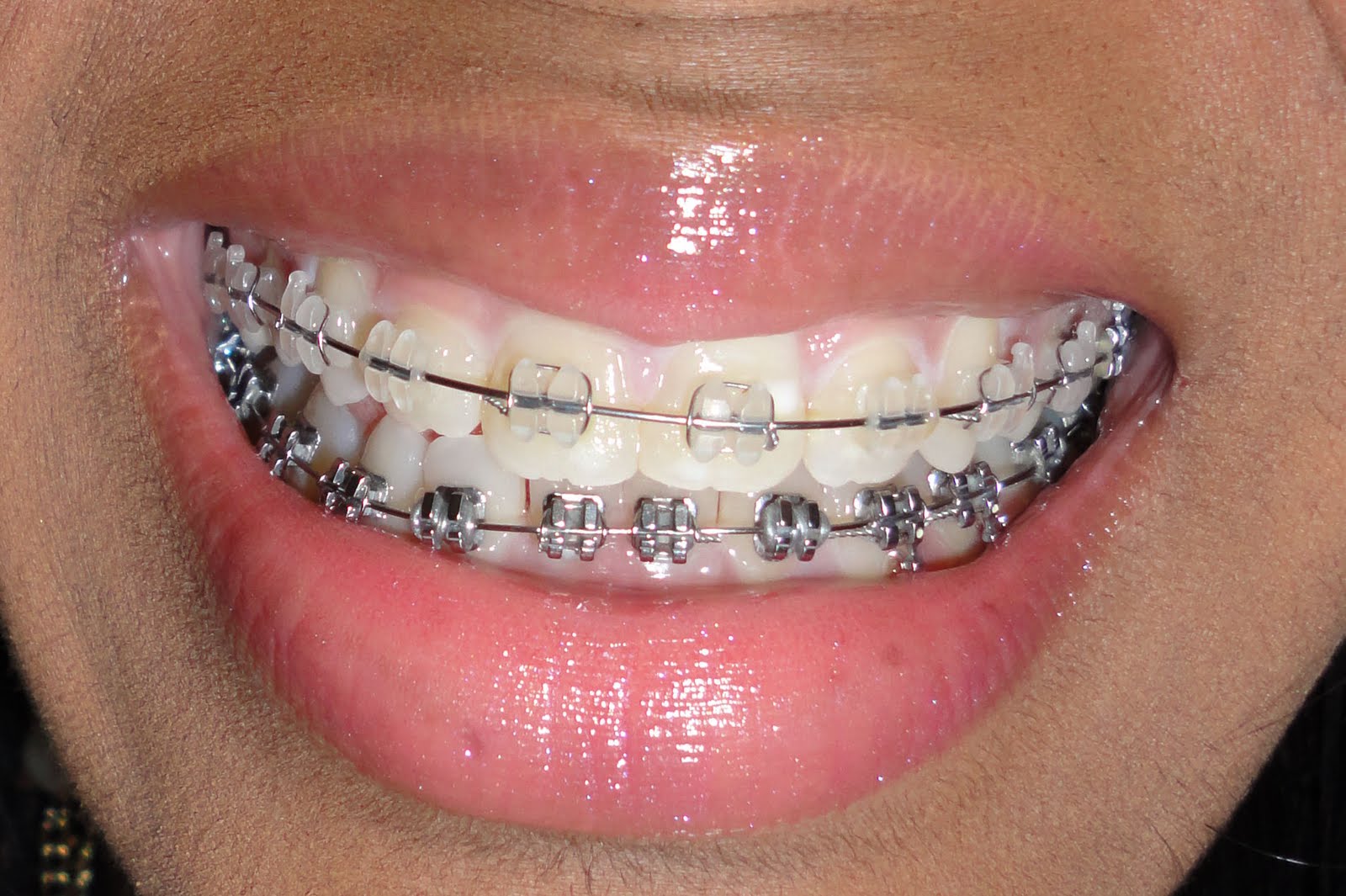 My Braces Experience