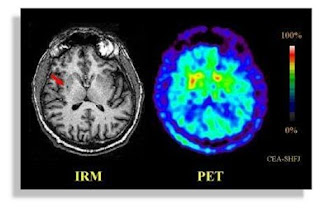 tomografia por emision de positrones