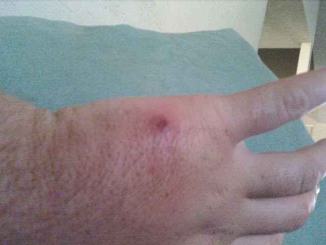 Spider Bite - Type Animals