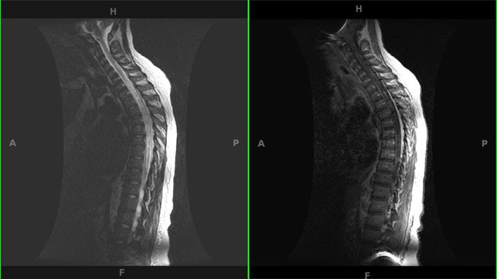 MRI RadT 413 Class: Multiple Sclerosis of Thoracic Spine