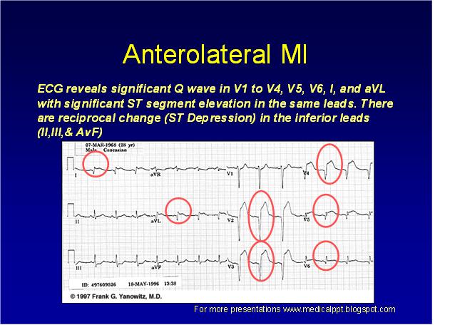 Emergency Medicine: Emergency Medicine: AMI