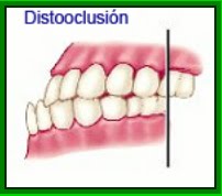 Tipos de Oclusión ~ Auxiliar de Odontología