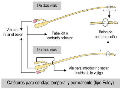 Tipos de Sondas Vesicales. | APUNTES AUXILIAR ENFERMERIA