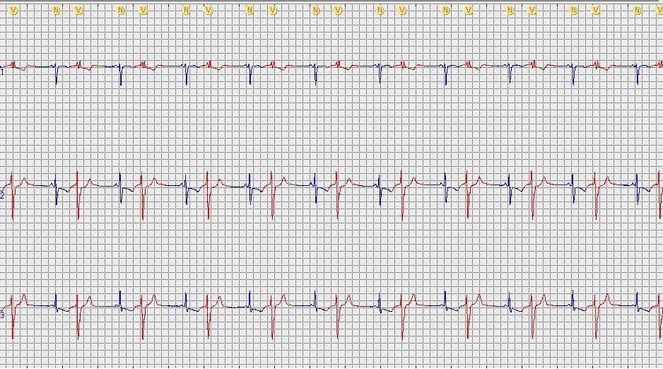 Atlas de Holter: BIGEMINISMO VENTRICULAR