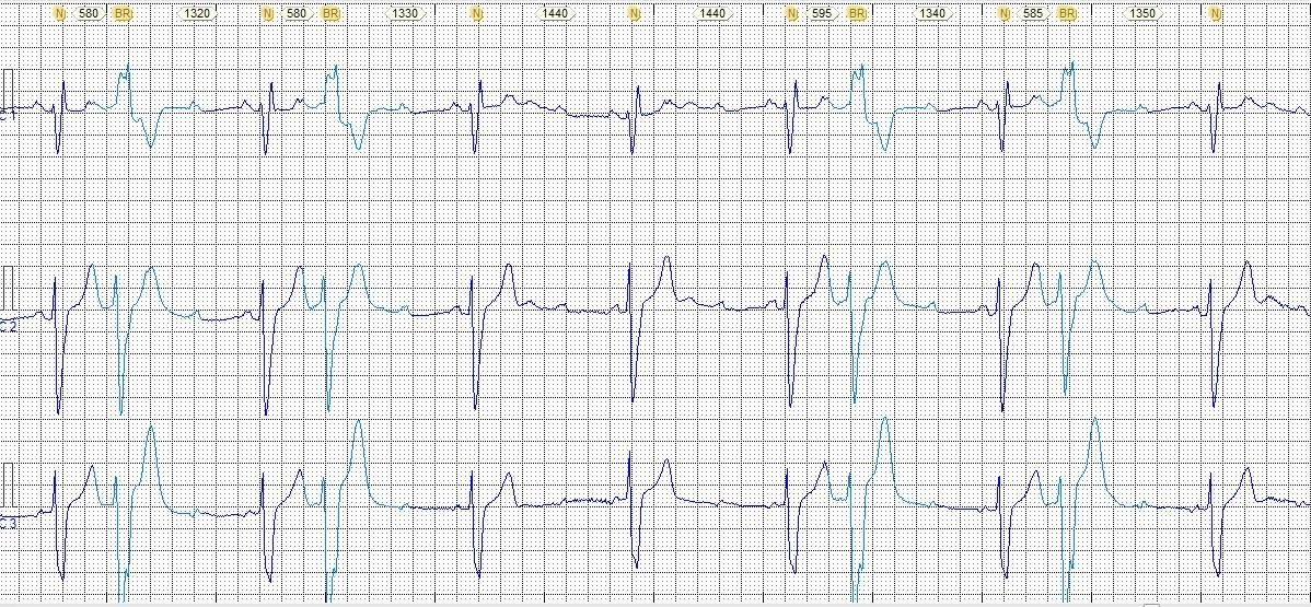 Atlas de Holter: FENOMENO ASHMAN