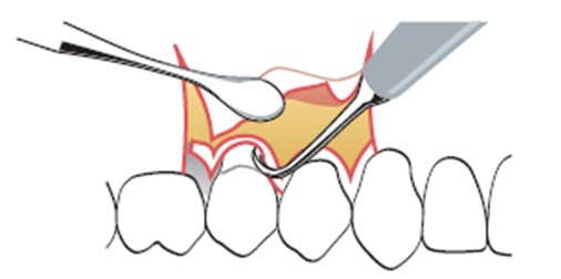 TERAPIA DE ACCESO Y VISIBILIDAD CX PERIODONTAL