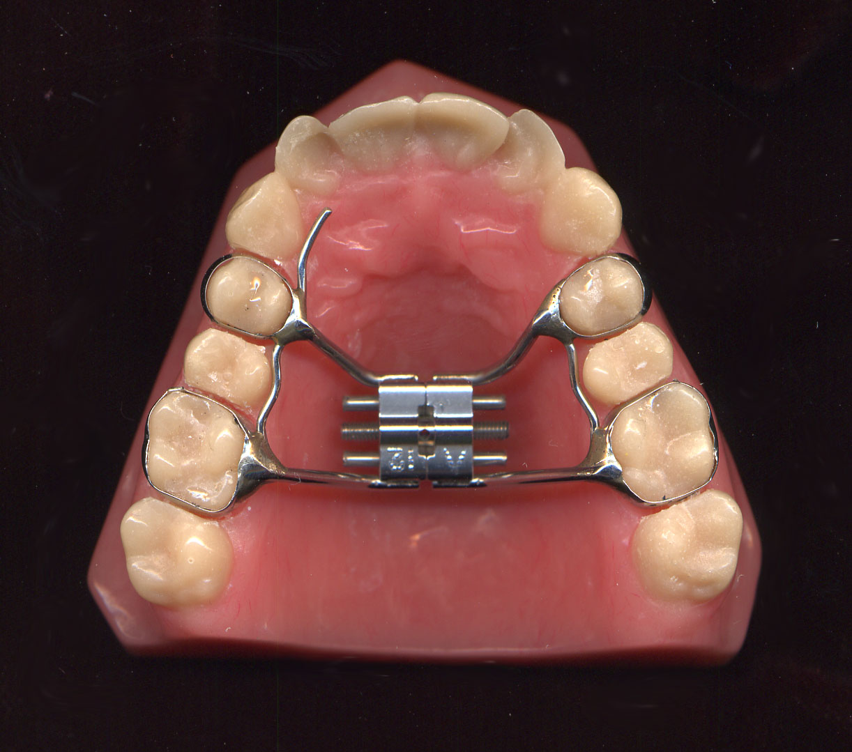 Ortodoncia Costa Rica: Hyrax