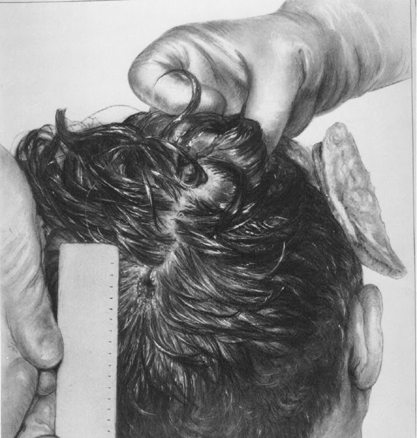 JFK ASSASSINATION: HOW COULD JFK'S EXIT WOUND BE IN THE RIGHT REAR OF ...