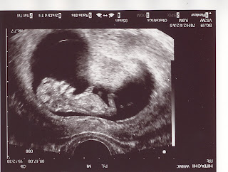 the beginning of pregnancy #2: 10 weeks, 6 days