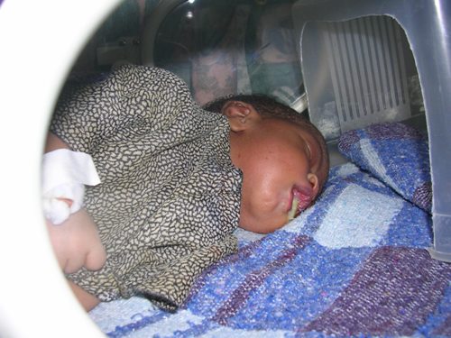 Chaaria Mission Hospital - Kenya: A case report on neonatal tetanus