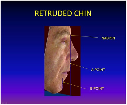 Facial Development Newsletter: HOW DO WE EVALUATE A PATIENT FOR ...
