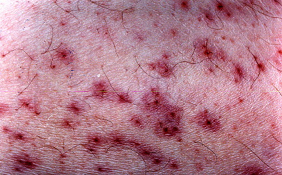 CIENCIAS PARA EL MUNDO CONTEMPORÁNEO: Enfermedad purpura.