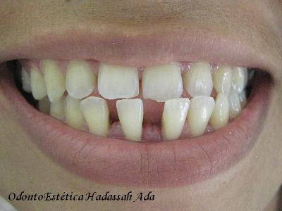Clareamento Dent Rio - Tel: 3936-8037: Como se junta dentes separados ...