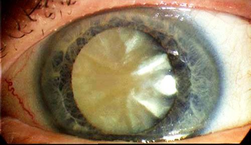 Choroby očí: Sivý zákal (katarakta)