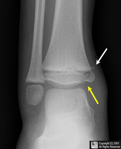anatomy and physiology: Types of Fractures