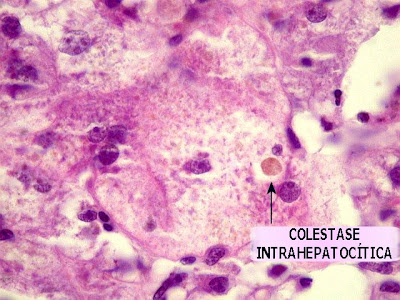 PatoloMed: Colestase