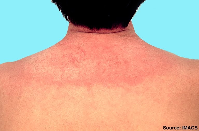 Horses and Zebras: Dermatomyositis