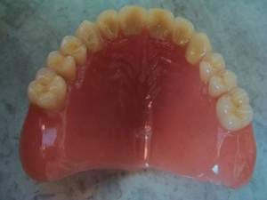 Prótesis Total 2 nivel AALD: Prótesis Total