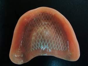 Prótesis Total 2 nivel AALD: Prótesis Total