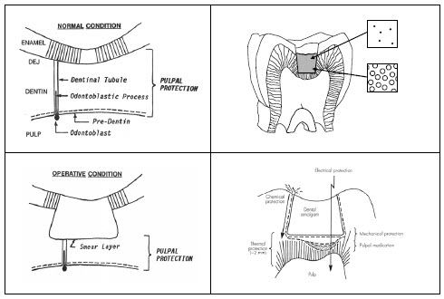 Dental Resource: Pulpal Protection: Varnishes, Liners, Bases