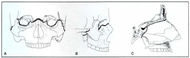 Fractures du massif facial supérieur