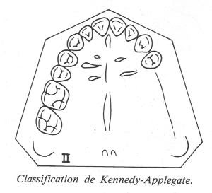 Classification des édentements