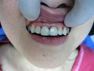 My ♥ Dentistry ☆: PFM Crown change to Full Cramic Crown