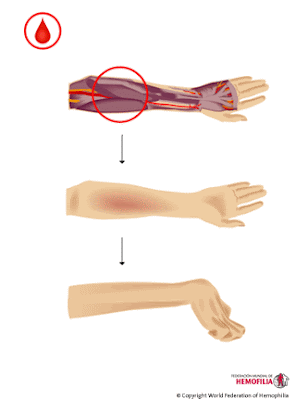 Hemofilia: La Hemofilia En Imagenes - Parte 02 - Evaluación y Manejo de ...