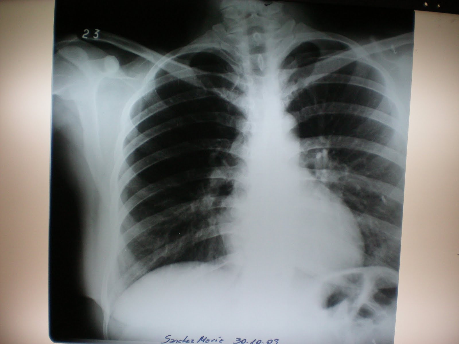 RXDOMINICOS: TORAX PRO. PA placas defectuosas