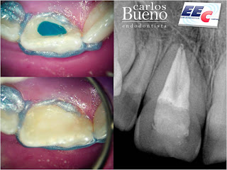 EQUIPE DE ENDODONTIA DE CAMPINAS: Caso Clínico de Geminação Dental ...