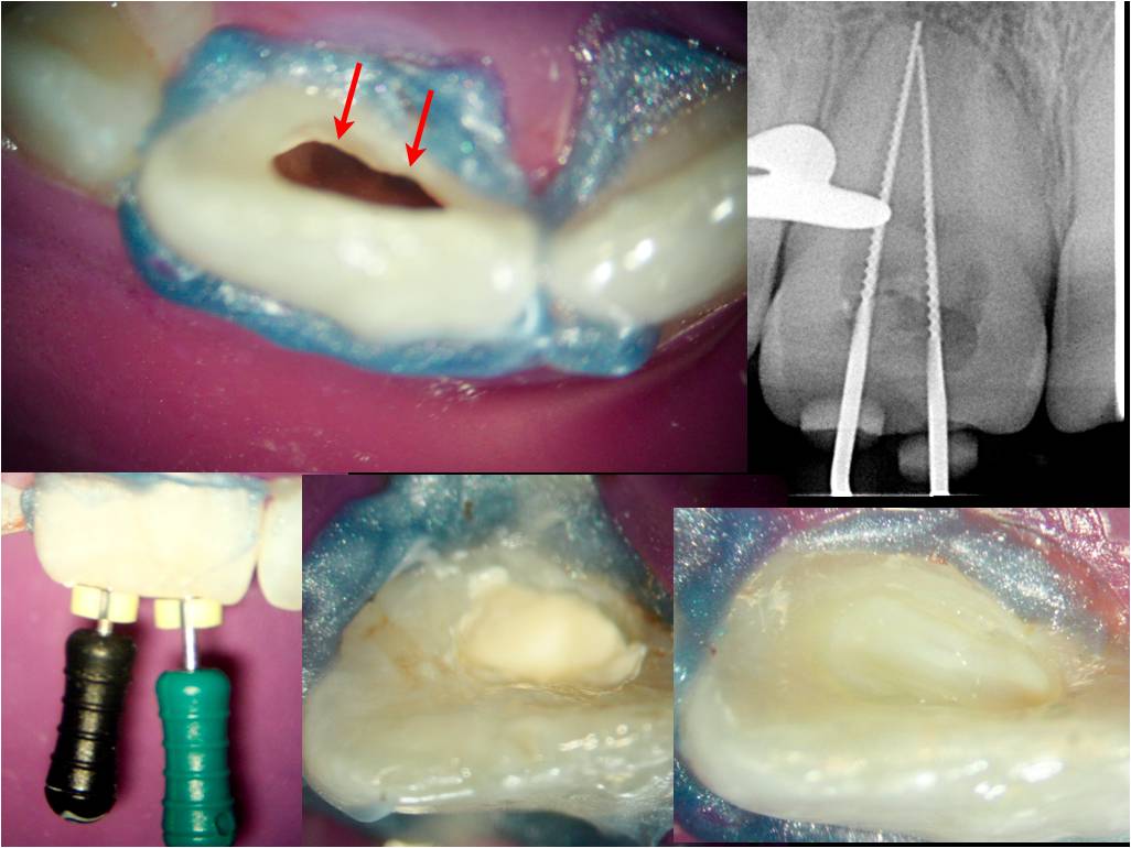 EQUIPE DE ENDODONTIA DE CAMPINAS: Caso Clínico de Geminação Dental ...