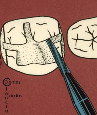Figura 04.- Reduccion oclusal