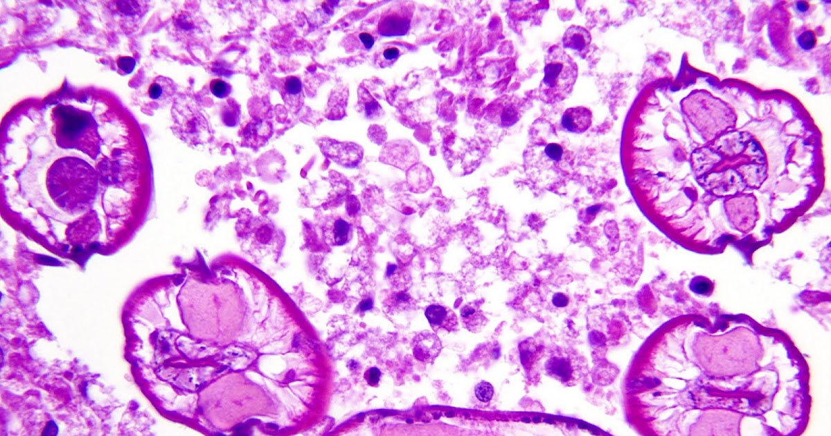 neuropathology blog: Best Post of September '09 - A Case of Cerebral ...